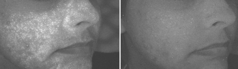 Acne Treatment - Skin Temple